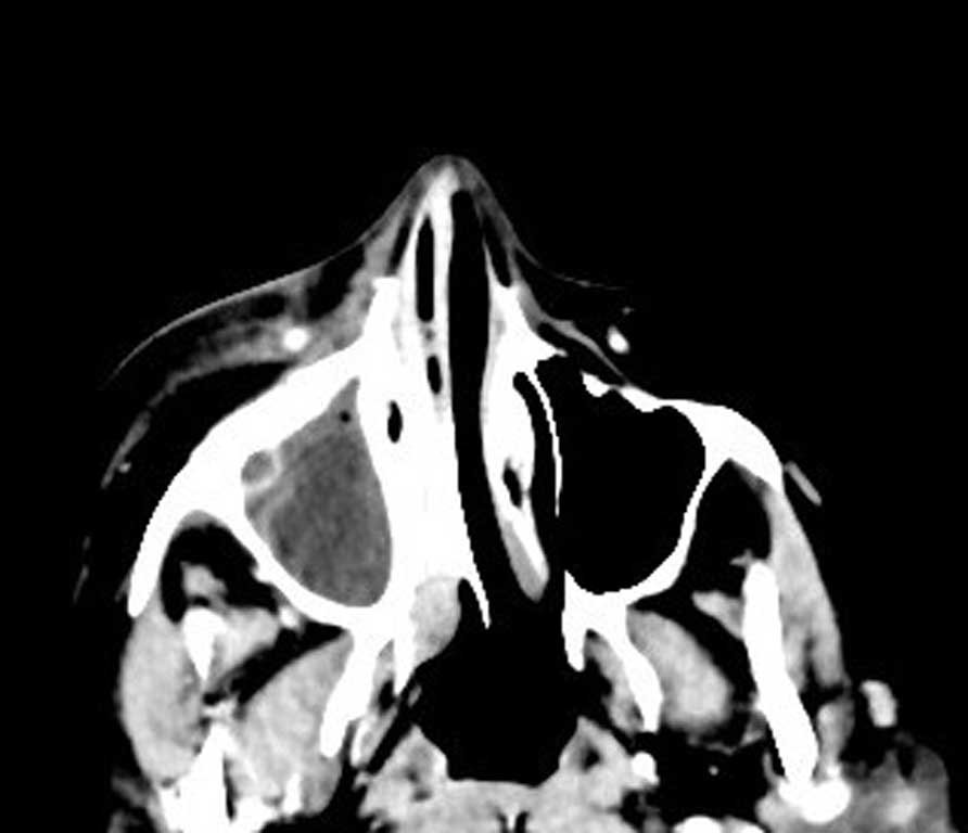 An unusual presentation of an intraorbital abscess associated with an ... An unusual presentation of an intraorbital abscess associated with an ...